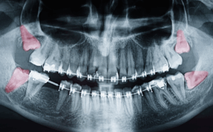 Why Do Wisdom Teeth Grow Sideways? Getting to the Root Cause - Oral ...